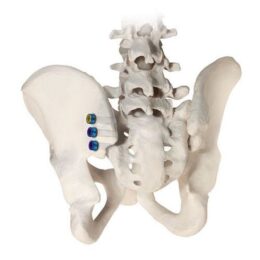 Sacroiliac (SI) Joint Fusion – The Spine Expert